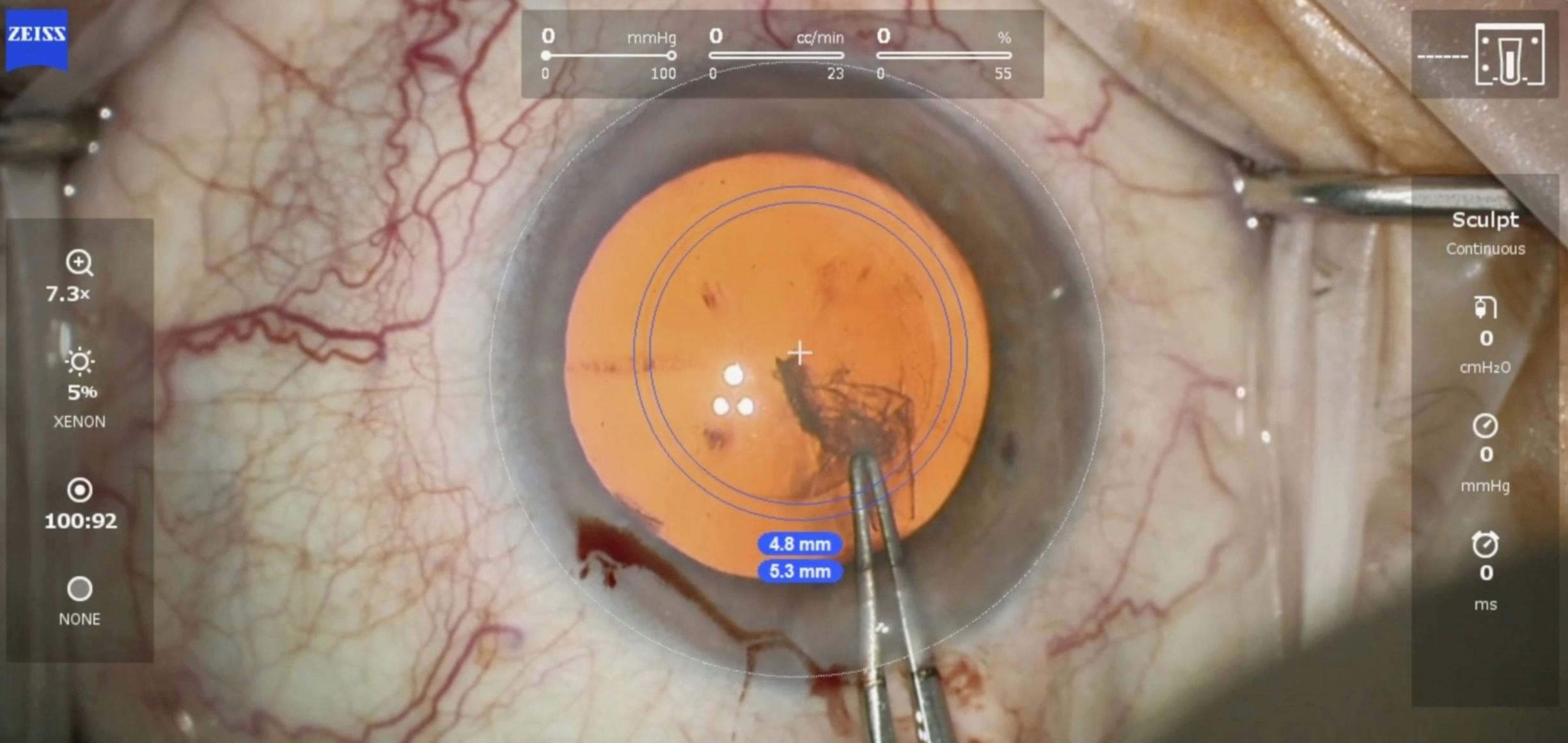 What Has Surprised Me the Most About the ZEISS ARTEVO 800's Visualization Capabilities - Eyetube